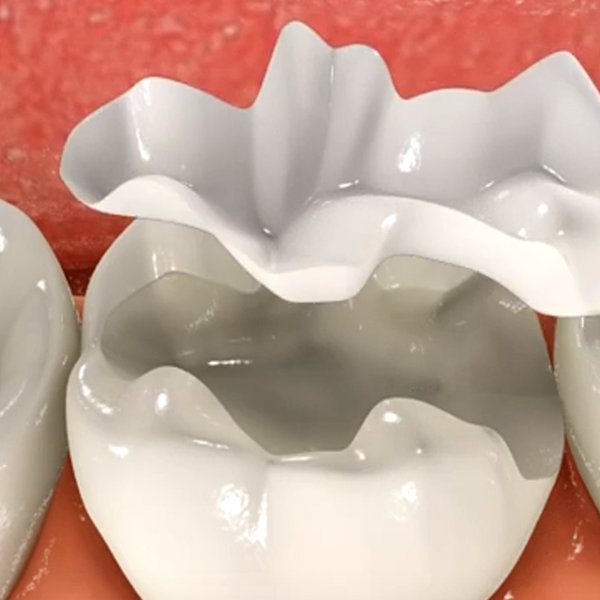 Porcelain Onlays in Modern Dentistry: Definition, Purpose, and Procedure